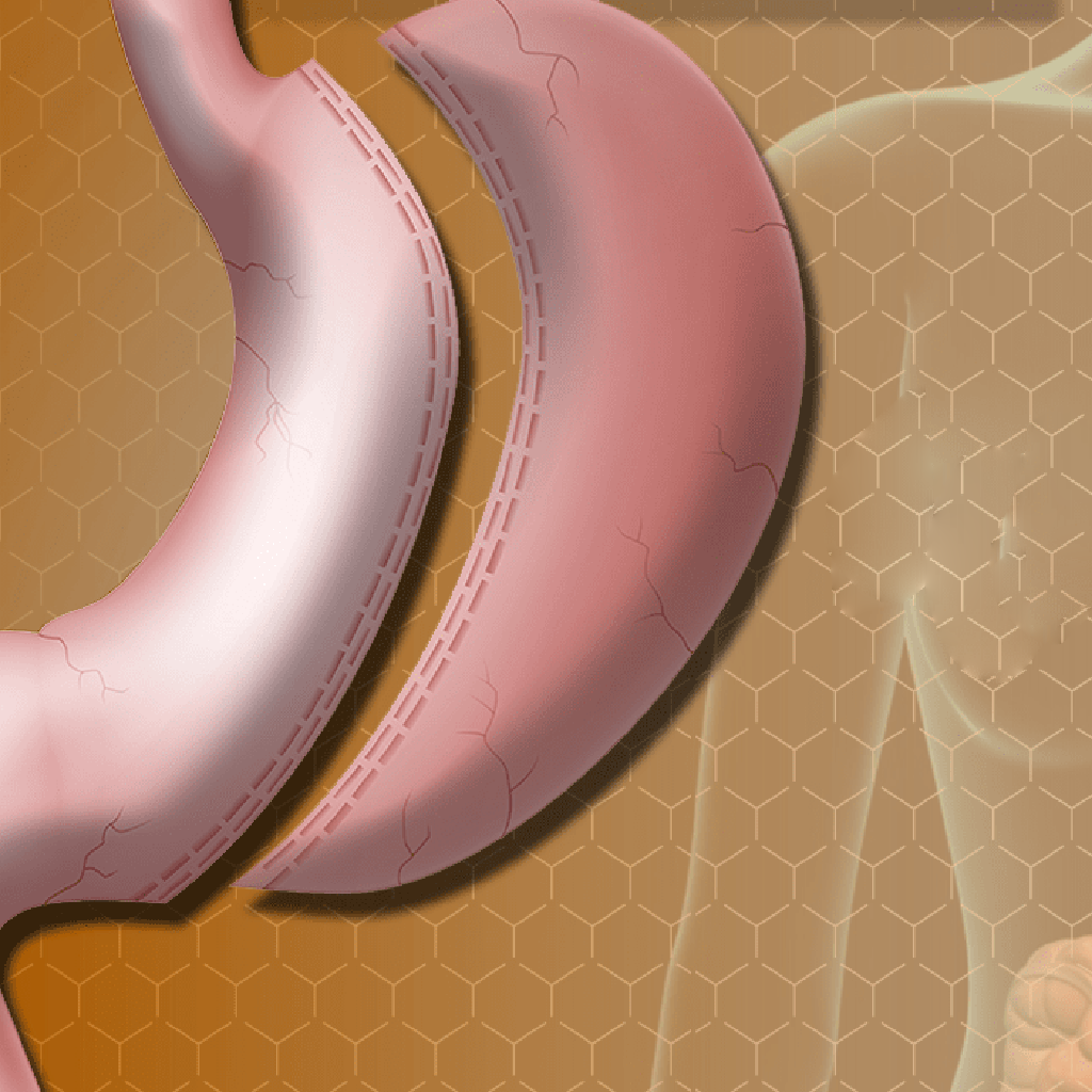 Mide Küçültme Operasyonları – Medical Dr. Guide